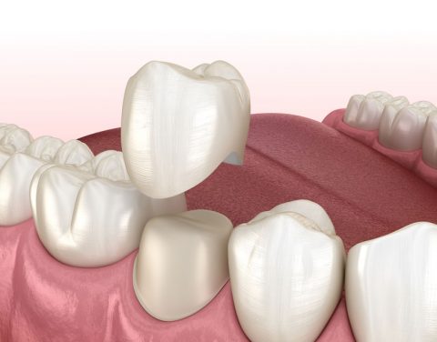 Esthetic Porcelain Crowns and Bridges - Sweet Dental